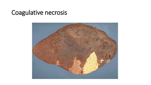 Necrosis.pptx definition, types, examples | PPTX | Blood Disorders ...