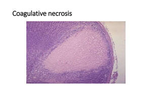 Necrosis.pptx definition, types, examples | PPTX | Blood Disorders ...