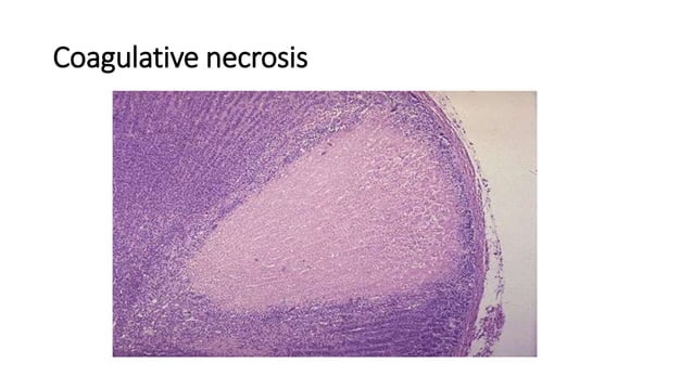 Necrosis.pptx definition, types, examples | PPTX | Blood Disorders ...