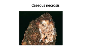 Necrosis.pptx definition, types, examples | PPTX | Blood Disorders ...