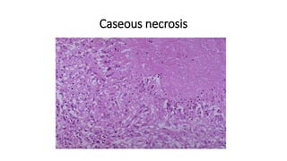 Necrosis.pptx definition, types, examples | PPTX | Blood Disorders ...