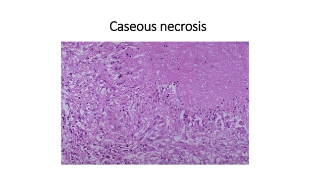 Necrosis.pptx definition, types, examples | PPTX | Blood Disorders ...