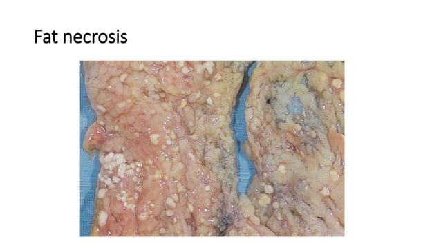 Necrosis.pptx definition, types, examples | PPTX | Blood Disorders ...
