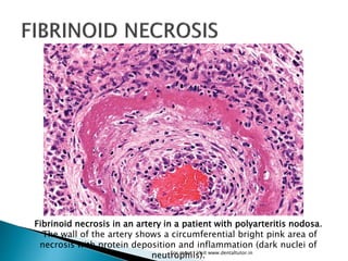 necrosis pathology by talha shahid .pptx