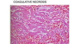 MORPHOLOGY OF CELL INJURY - NECROSIS.pptx