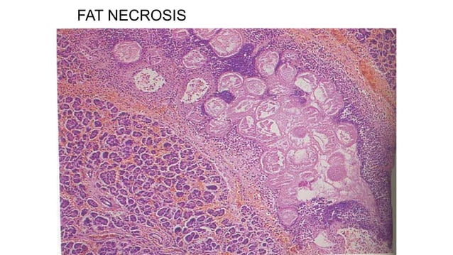 MORPHOLOGY OF CELL INJURY - NECROSIS.pptx