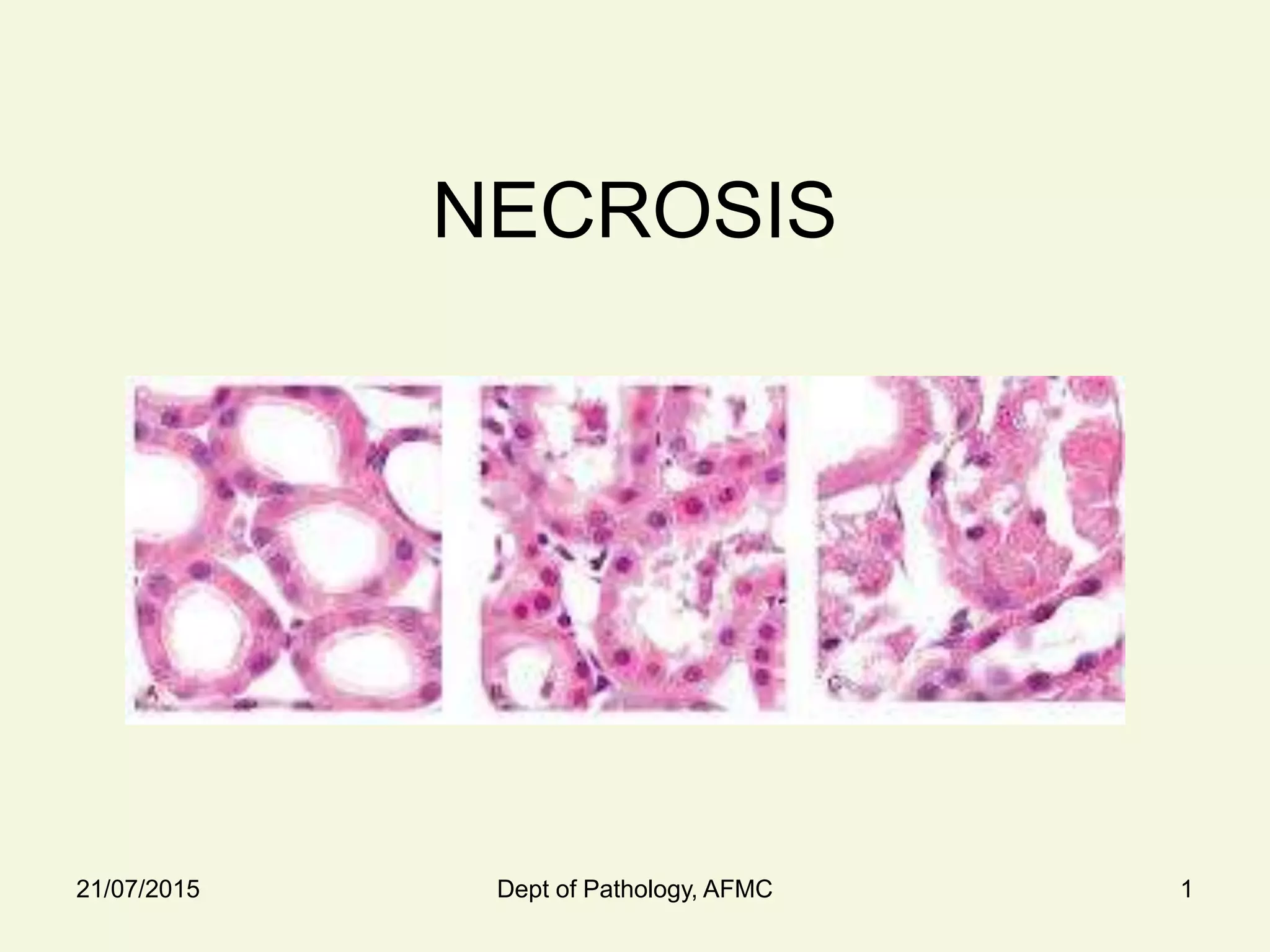 Necrosis and gangrene | PPT
