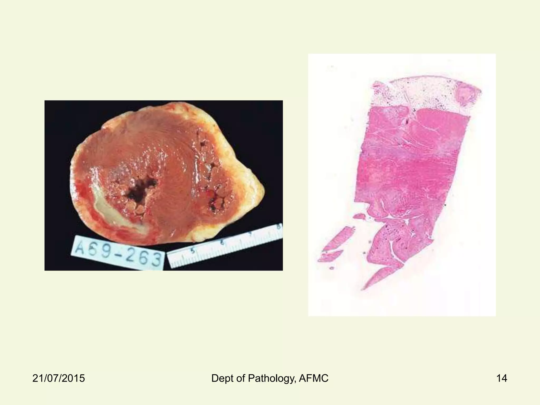 Necrosis and gangrene | PPT