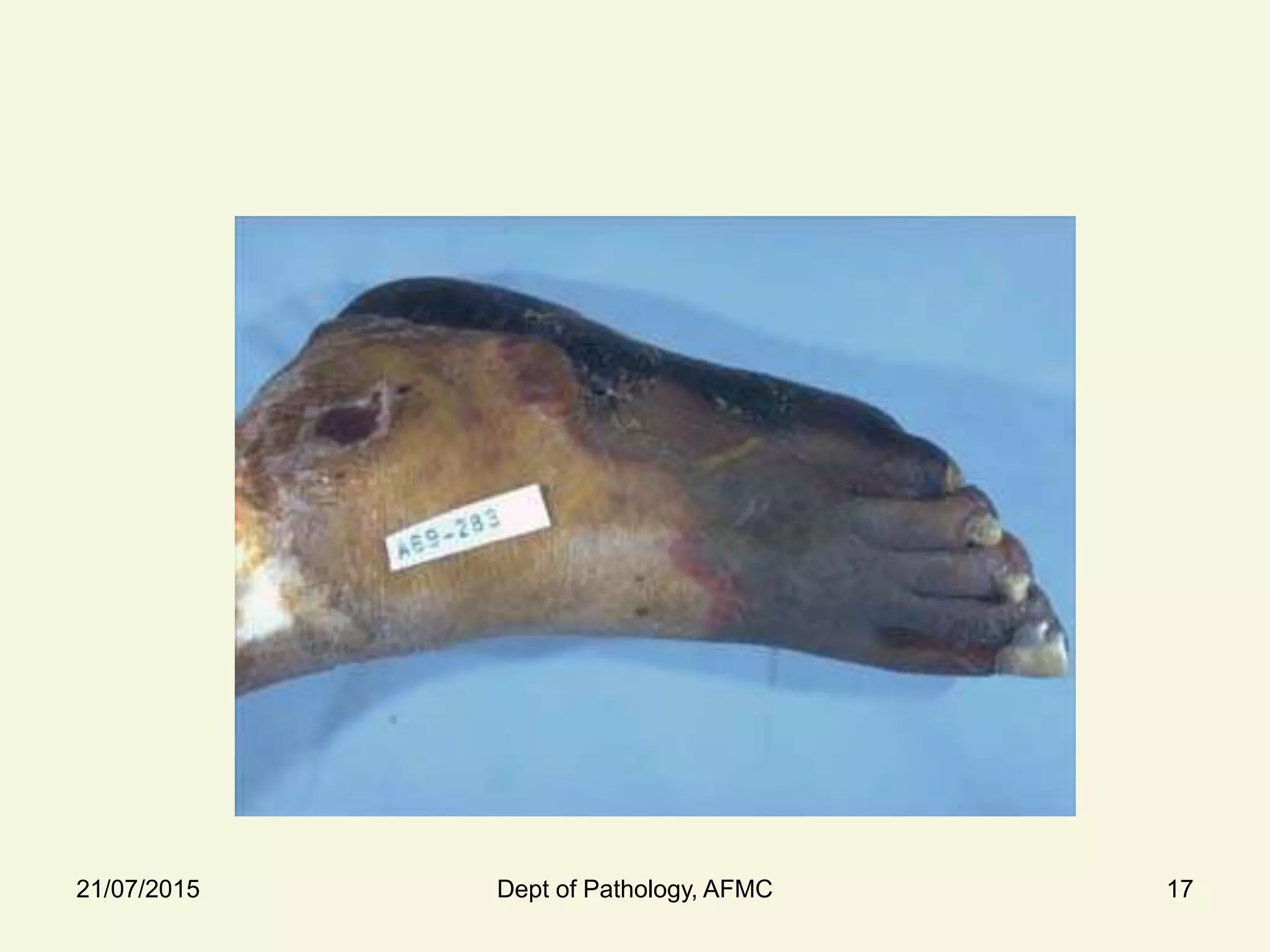 Necrosis and gangrene | PPT