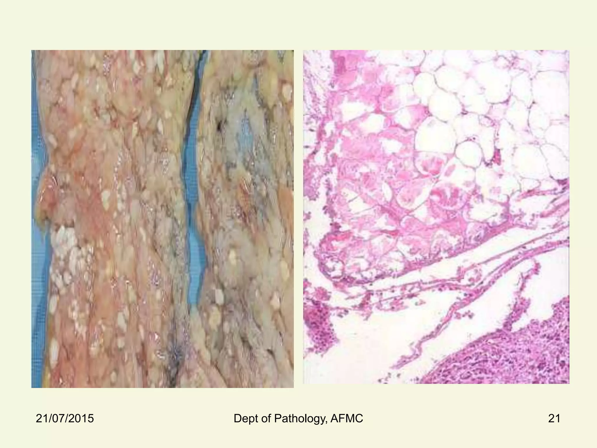 Necrosis and gangrene | PPT