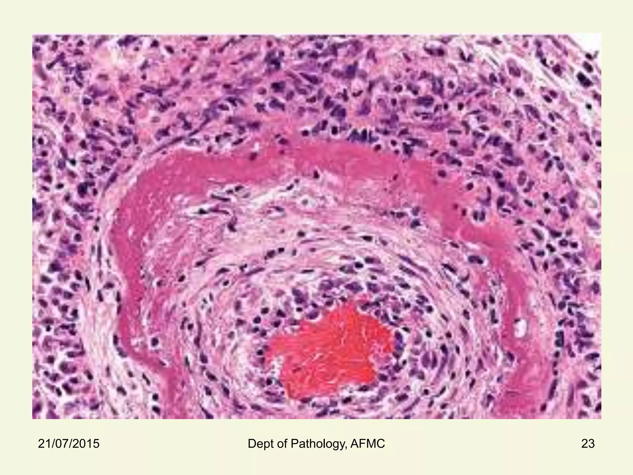 Necrosis and gangrene | PPT