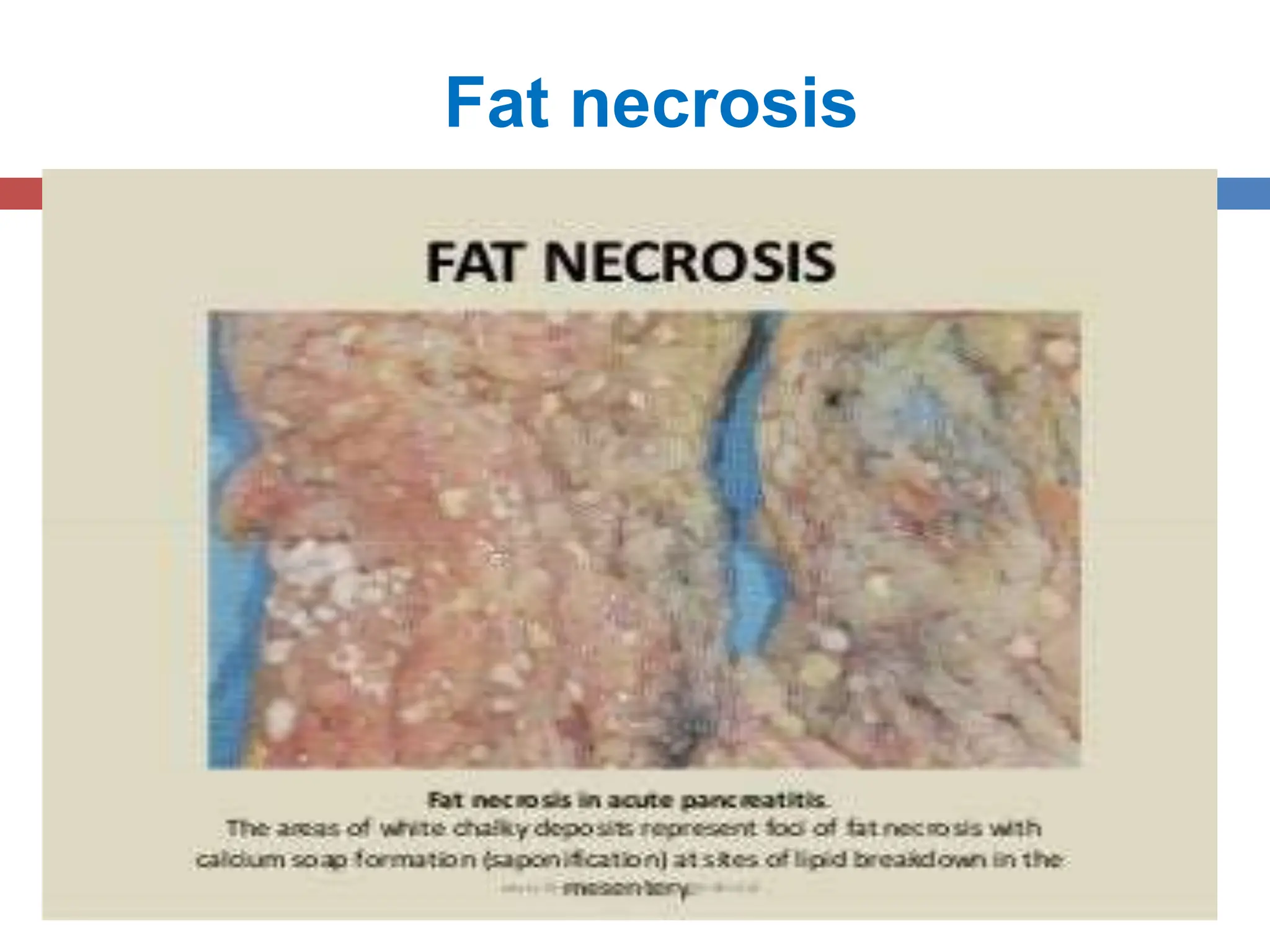 The Pathology necrosis and gangrene.pptx