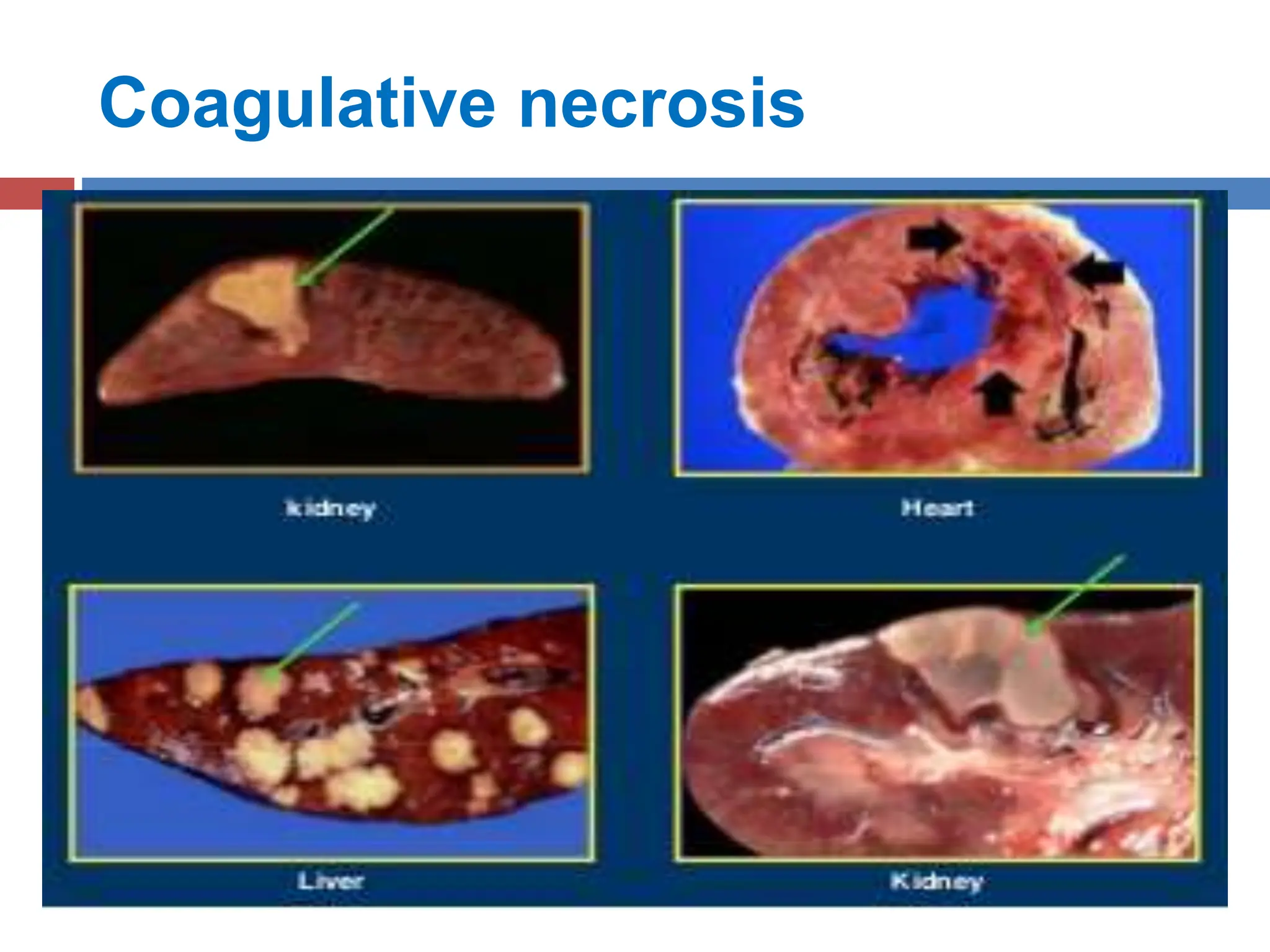 The Pathology necrosis and gangrene.pptx
