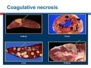The Pathology necrosis and gangrene.pptx