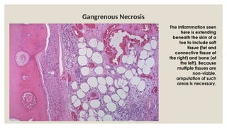 Necrosis and calcification overview.pptx