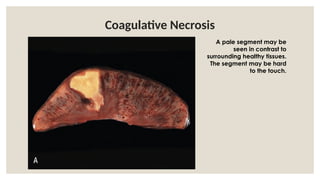 Necrosis and calcification overview.pptx