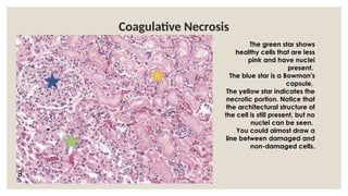 Necrosis and calcification overview.pptx