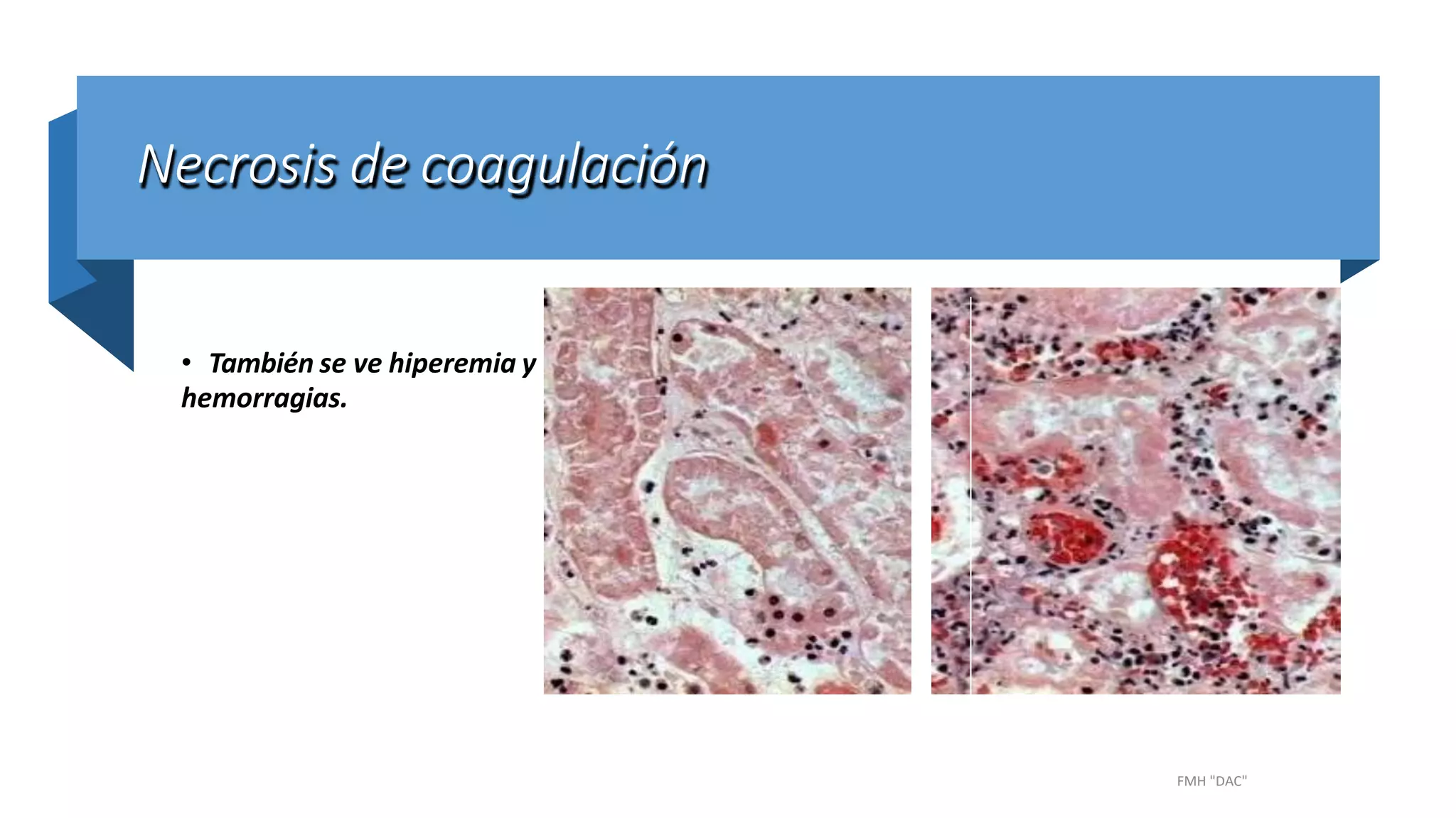 NECROSISCLASIFICACION.pptx