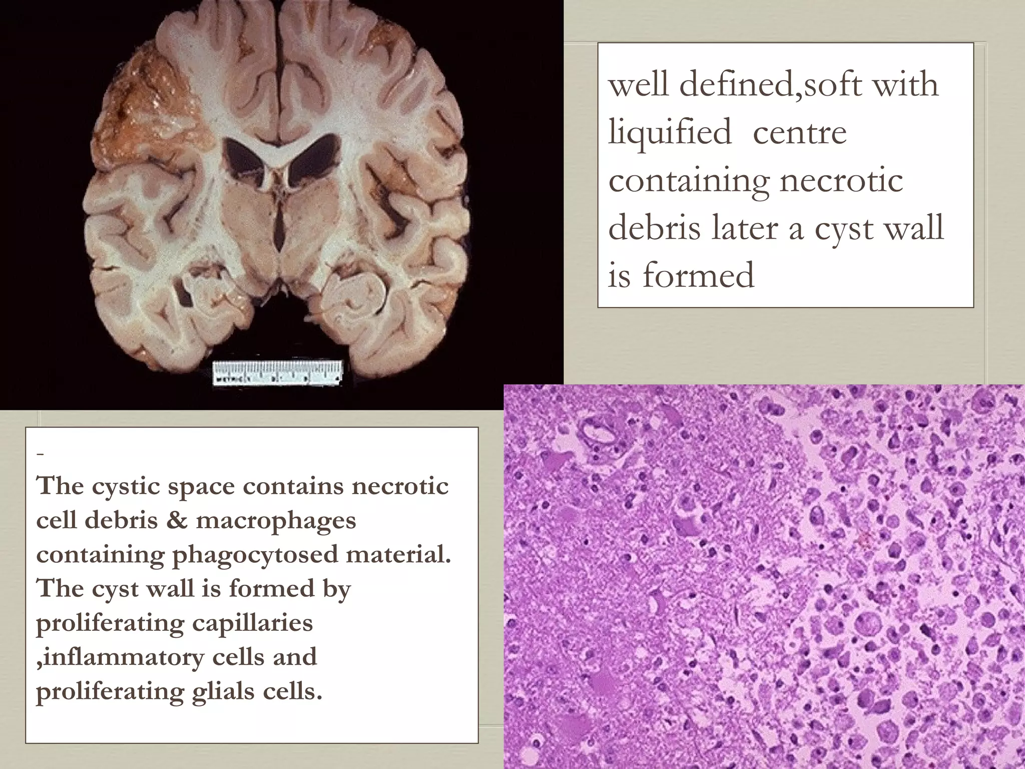 Necrosis & gangrene pathology calcification | PPT