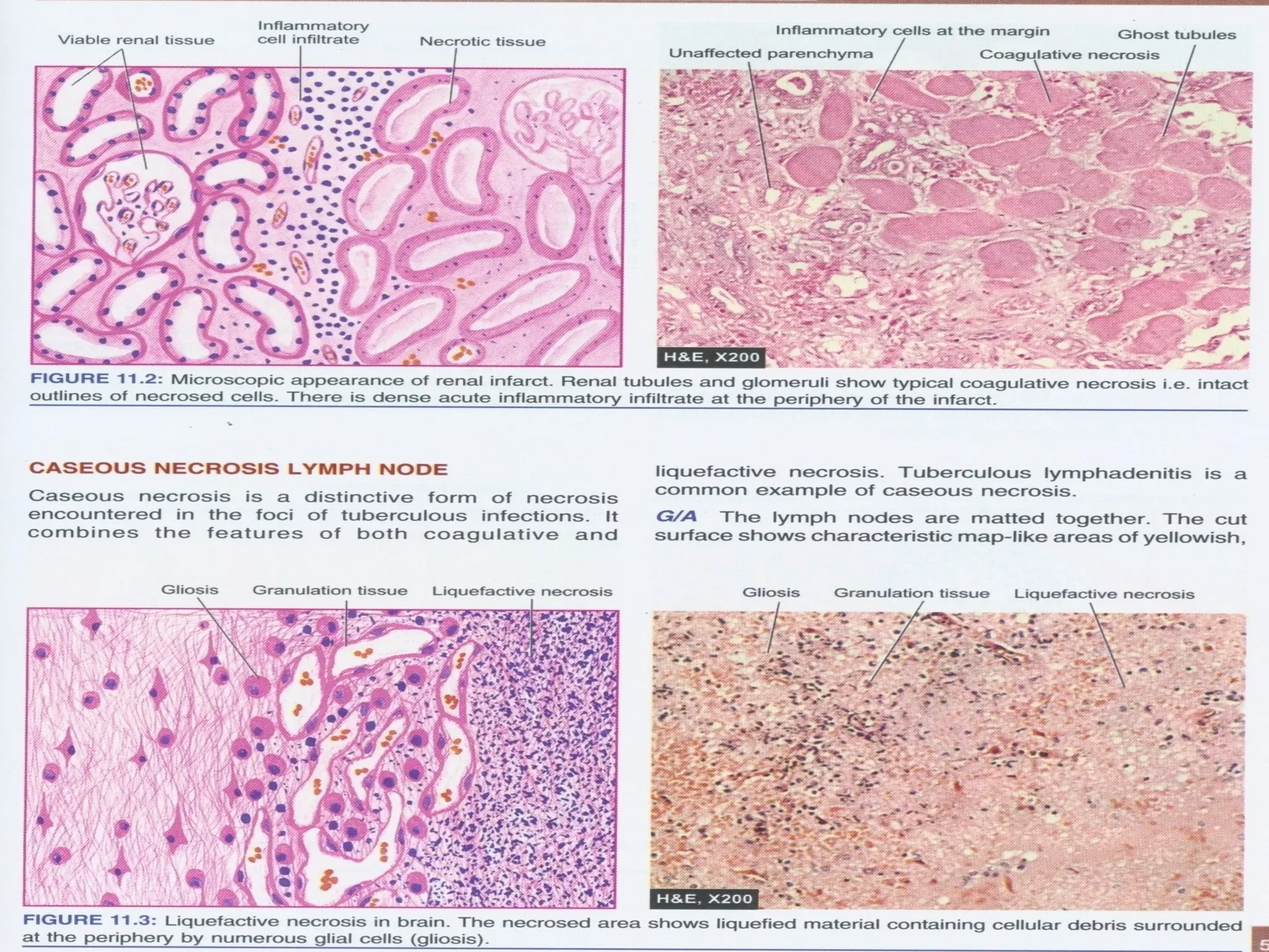 Necrosis & gangrene pathology calcification | PPT