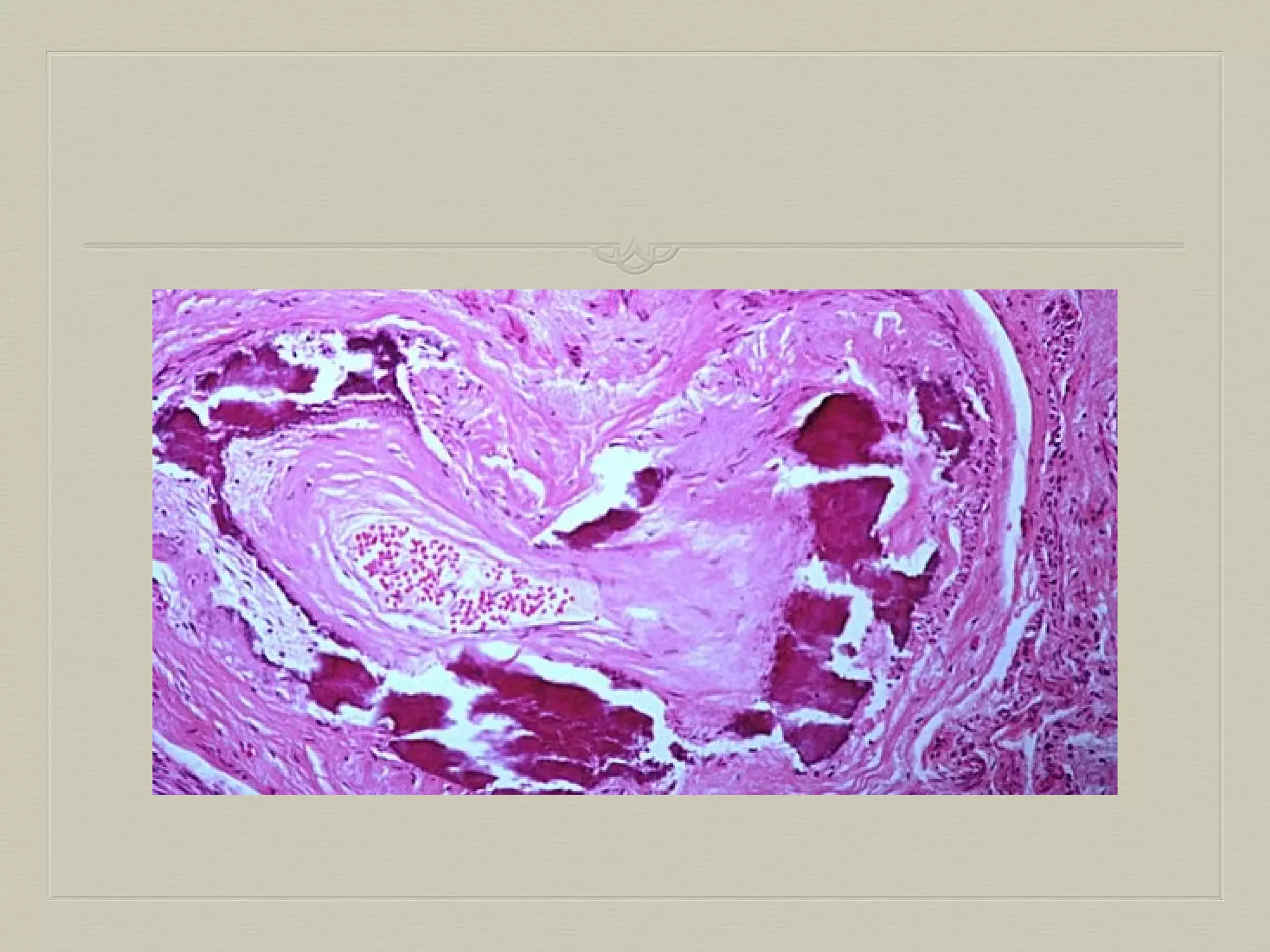 Necrosis & gangrene pathology calcification | PPT