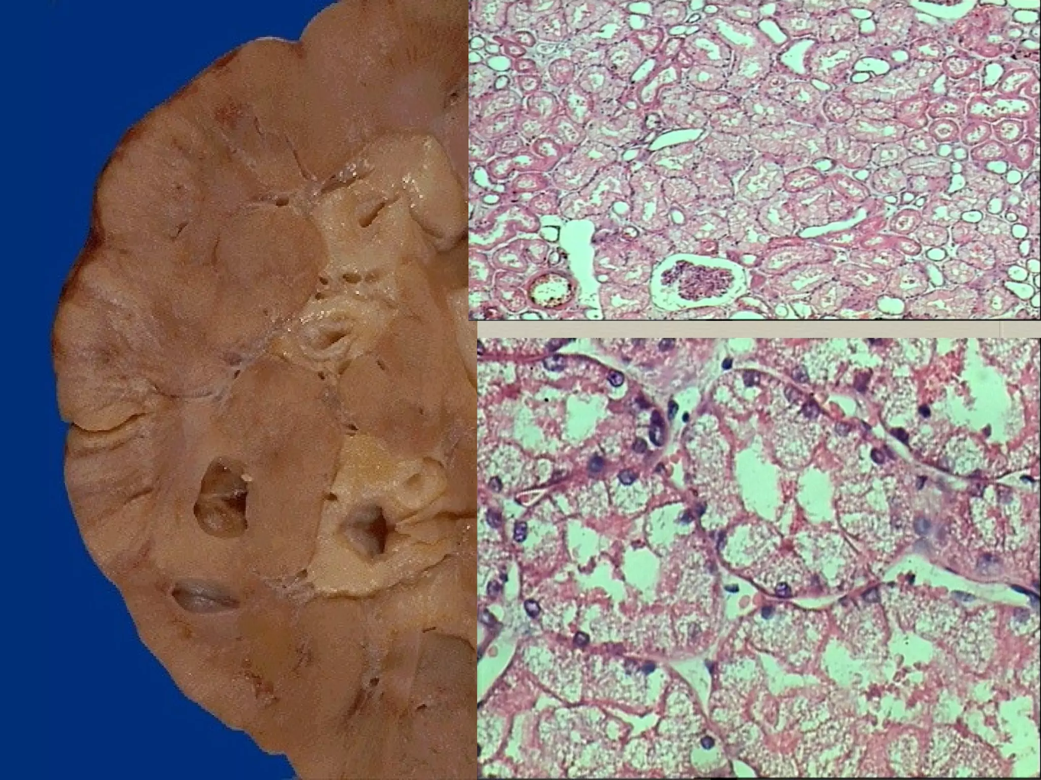 Necrosis & gangrene pathology calcification | PPT
