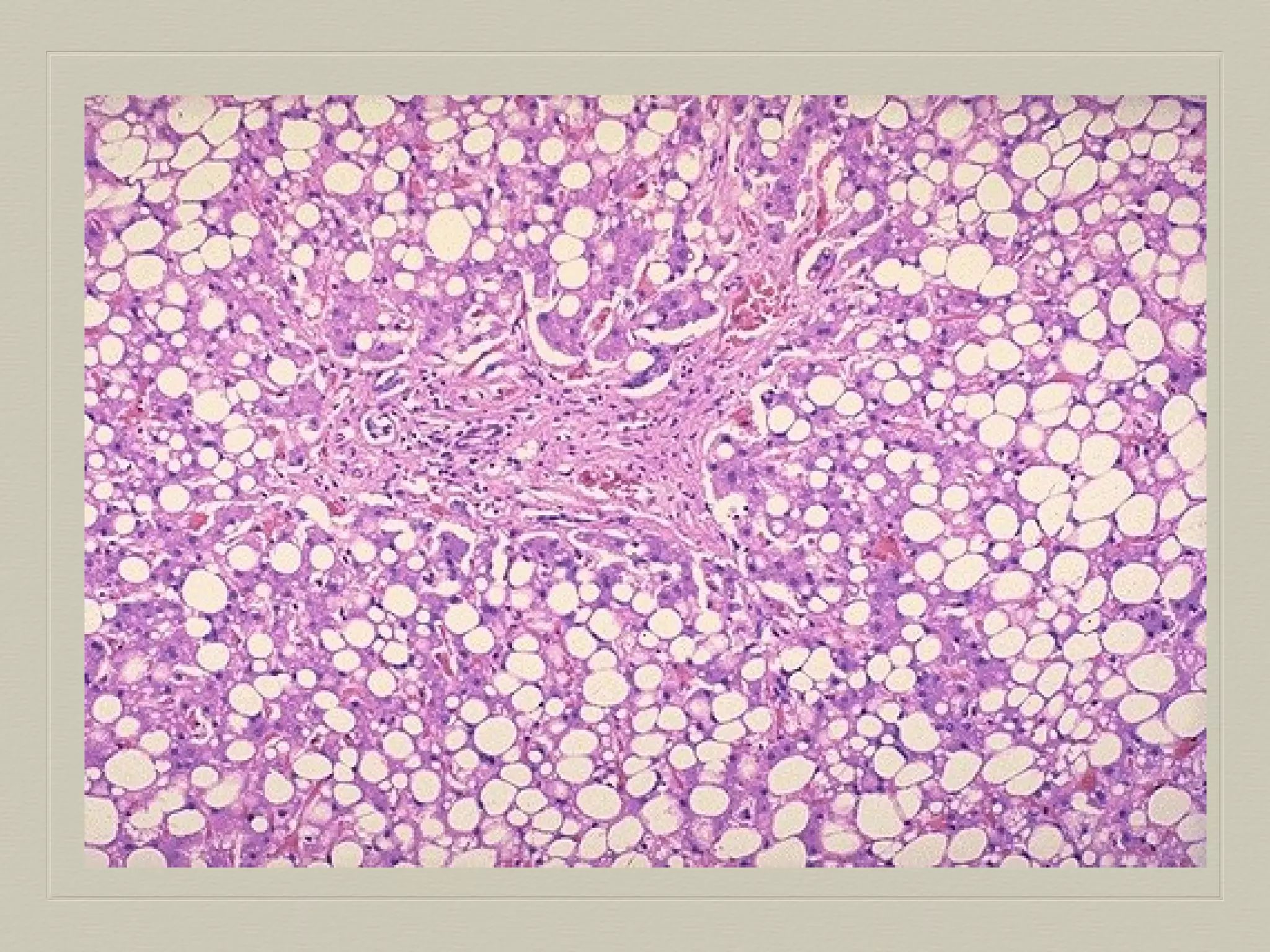 Necrosis & gangrene pathology calcification | PPT