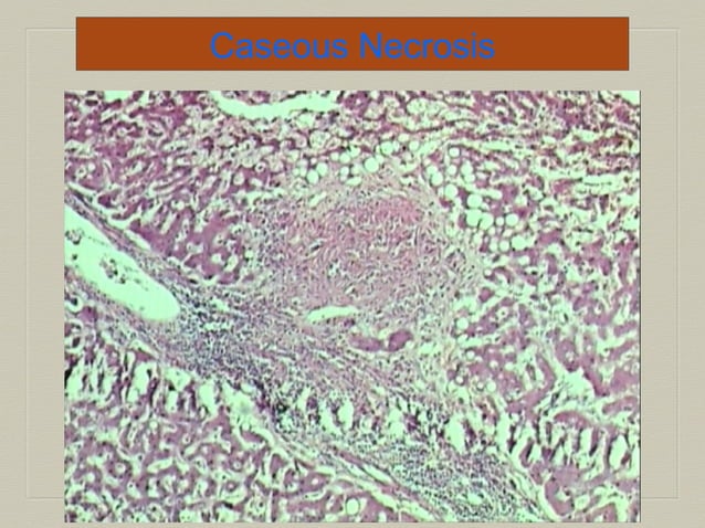 Necrosis & gangrene pathology calcification | PPT