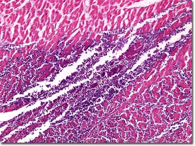 Necrosis & gangrene pathology calcification