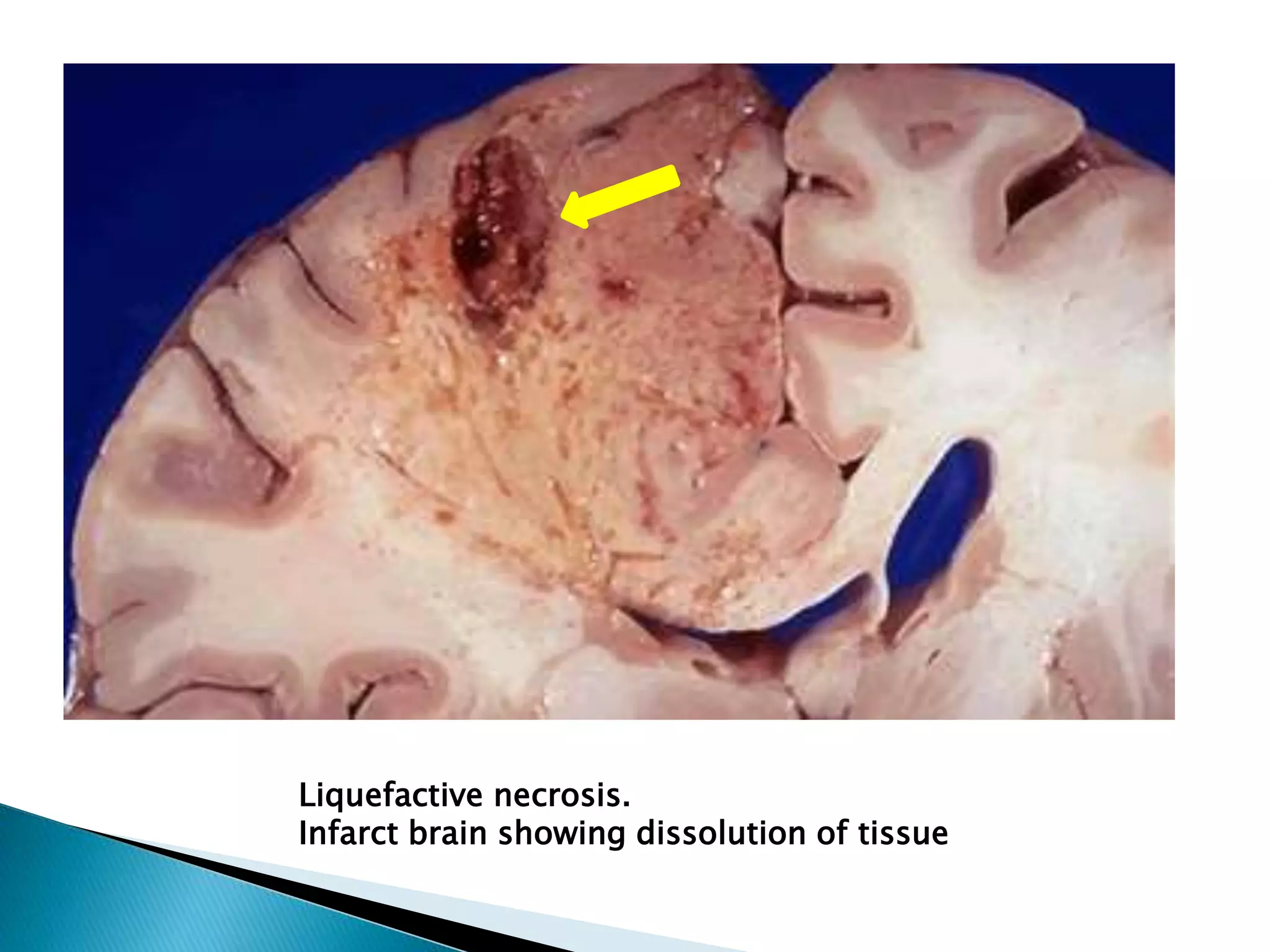 Necrosis,gangrene and apoptosis | PPTX