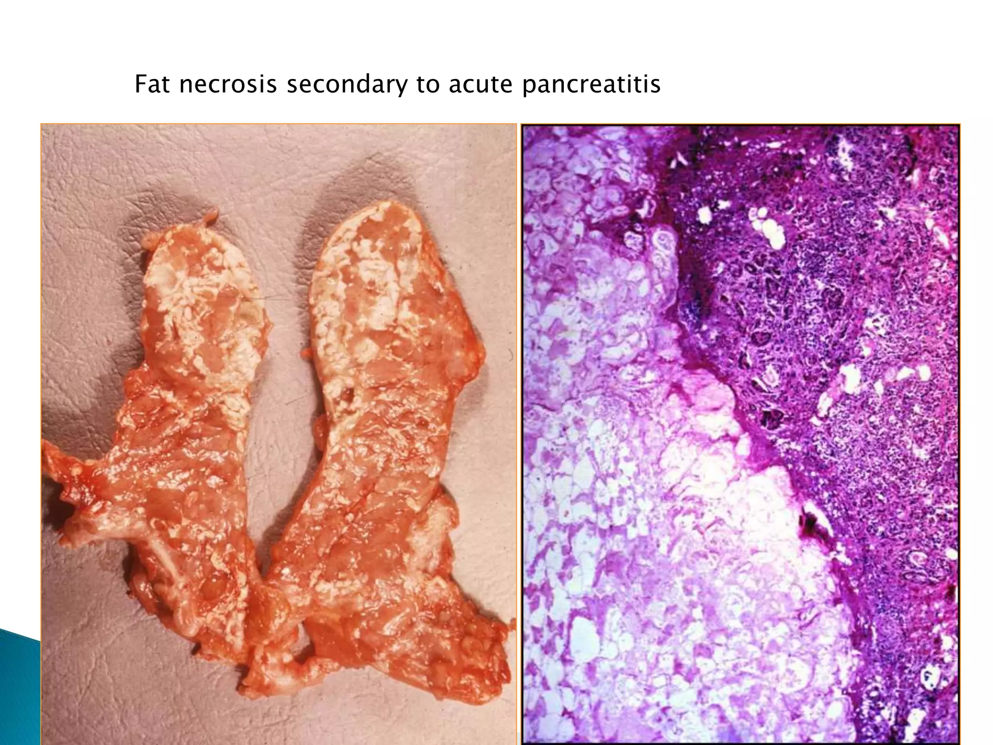 Necrosis,gangrene and apoptosis | PPTX