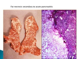 Necrosis,gangrene and apoptosis | PPTX