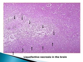 Liquefaction Necrosis Brain
