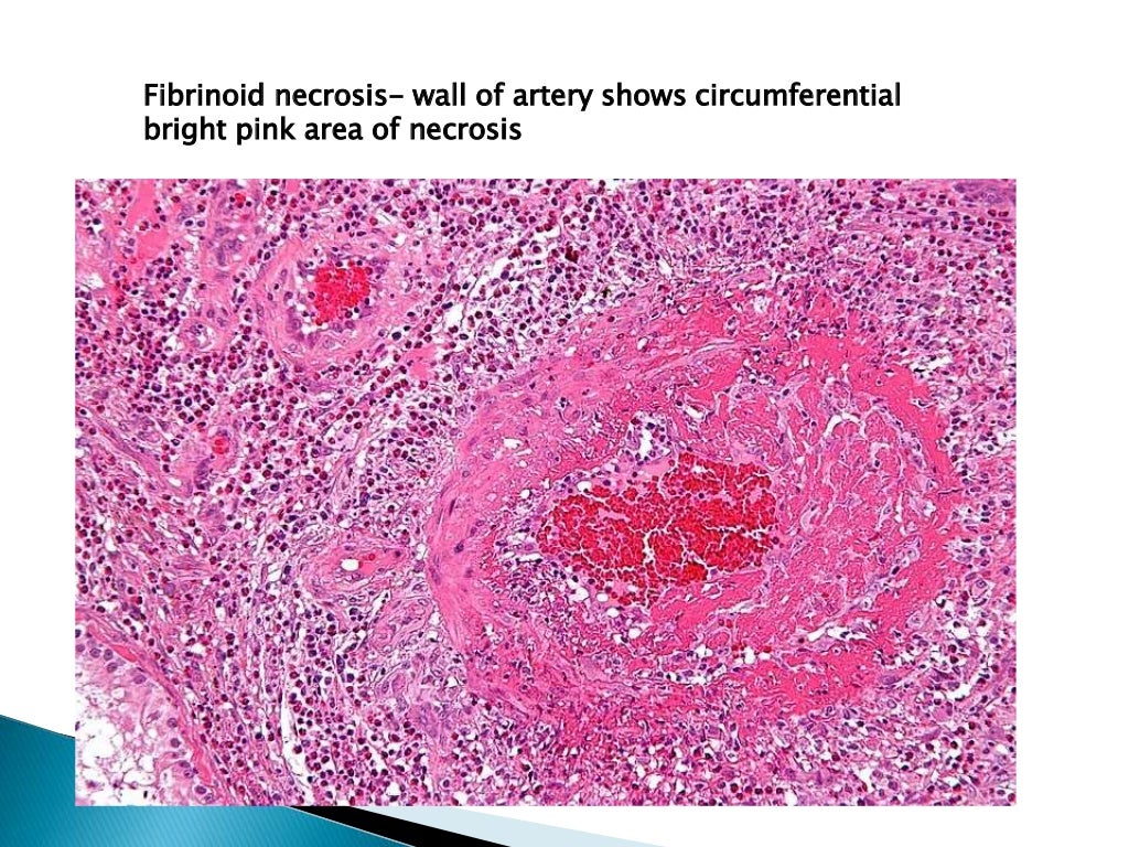 Necrosis,gangrene and apoptosis