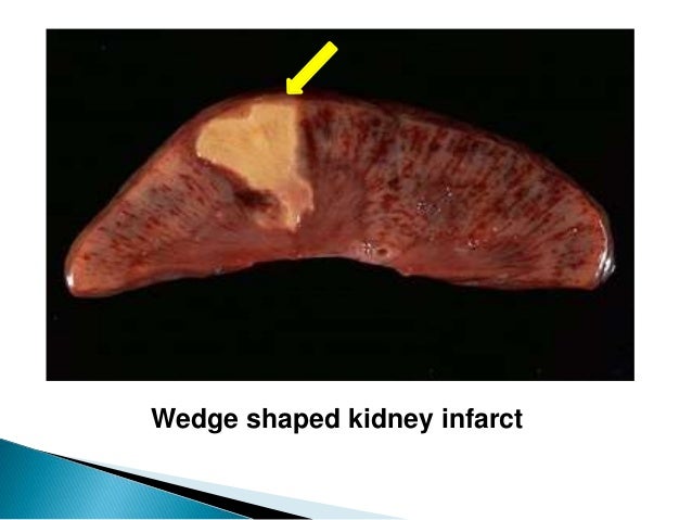 Pale Infarct Kidney