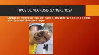 NECROSIS GANGRENOSA.pptx