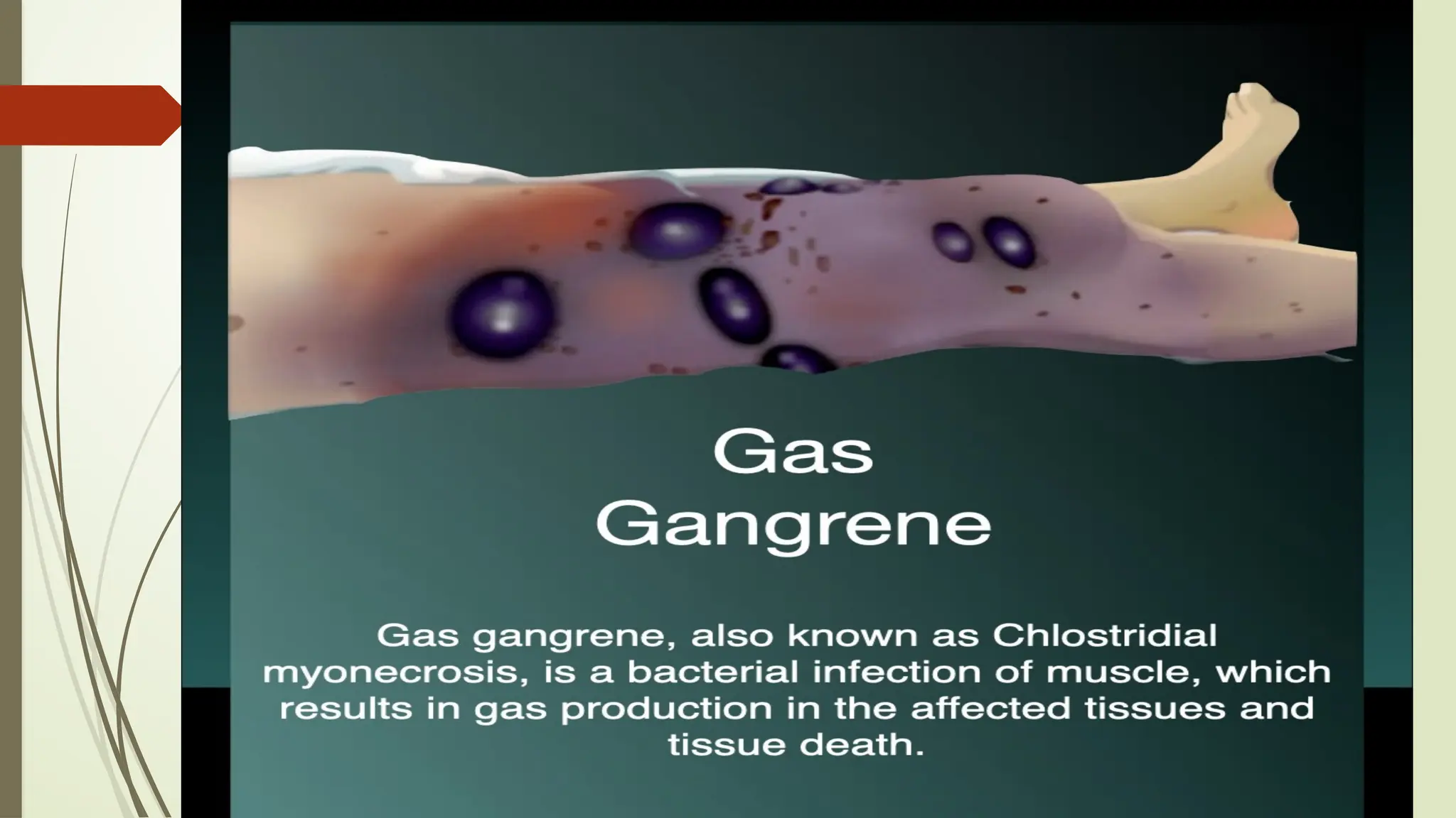 Necrosis^J Gangrene.pptx gas gangrene surgery | PPTX