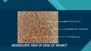NECROSIS PPT.power point presentations n | PPTX