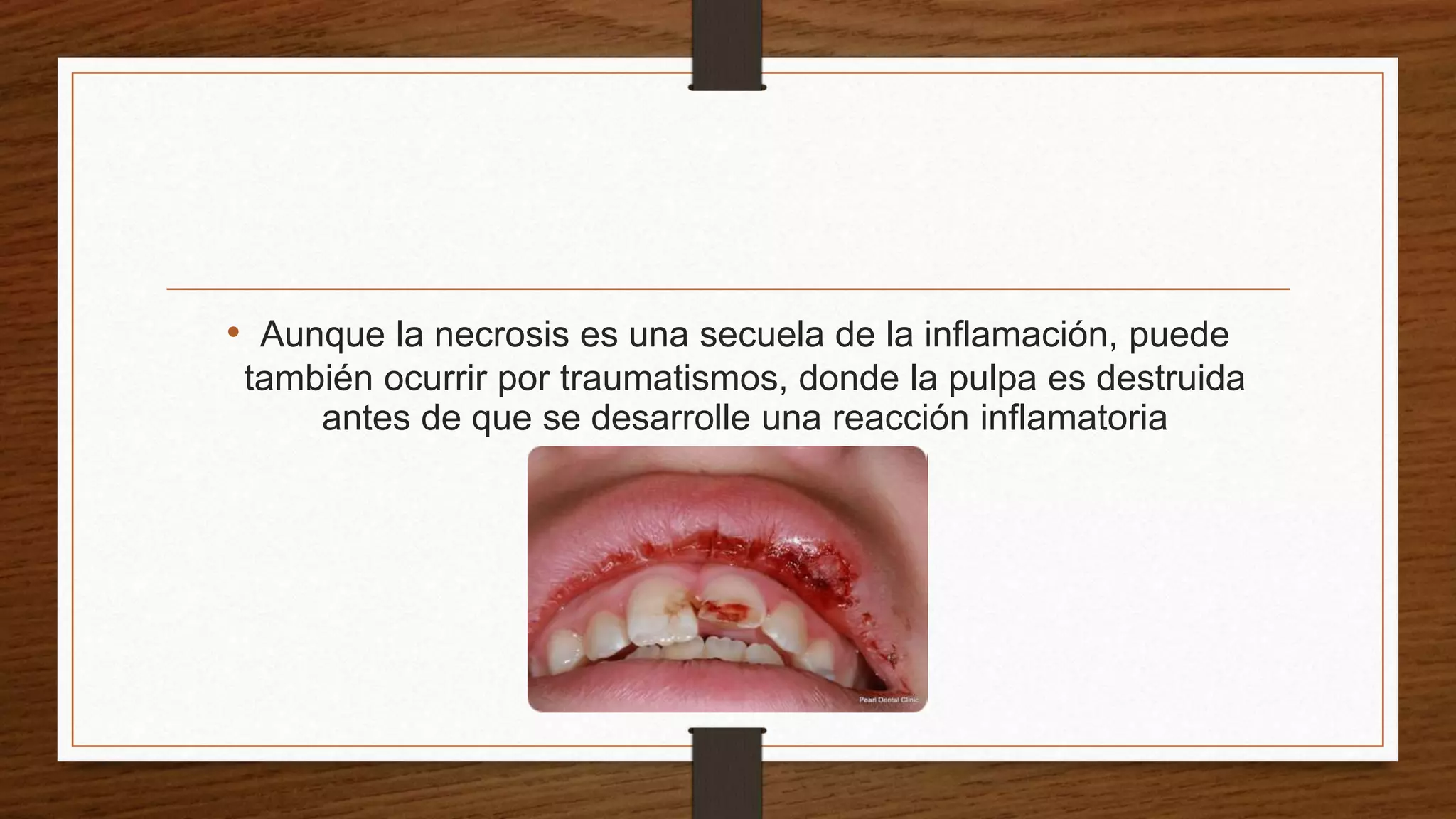 Necrosis pulpar | PPTX
