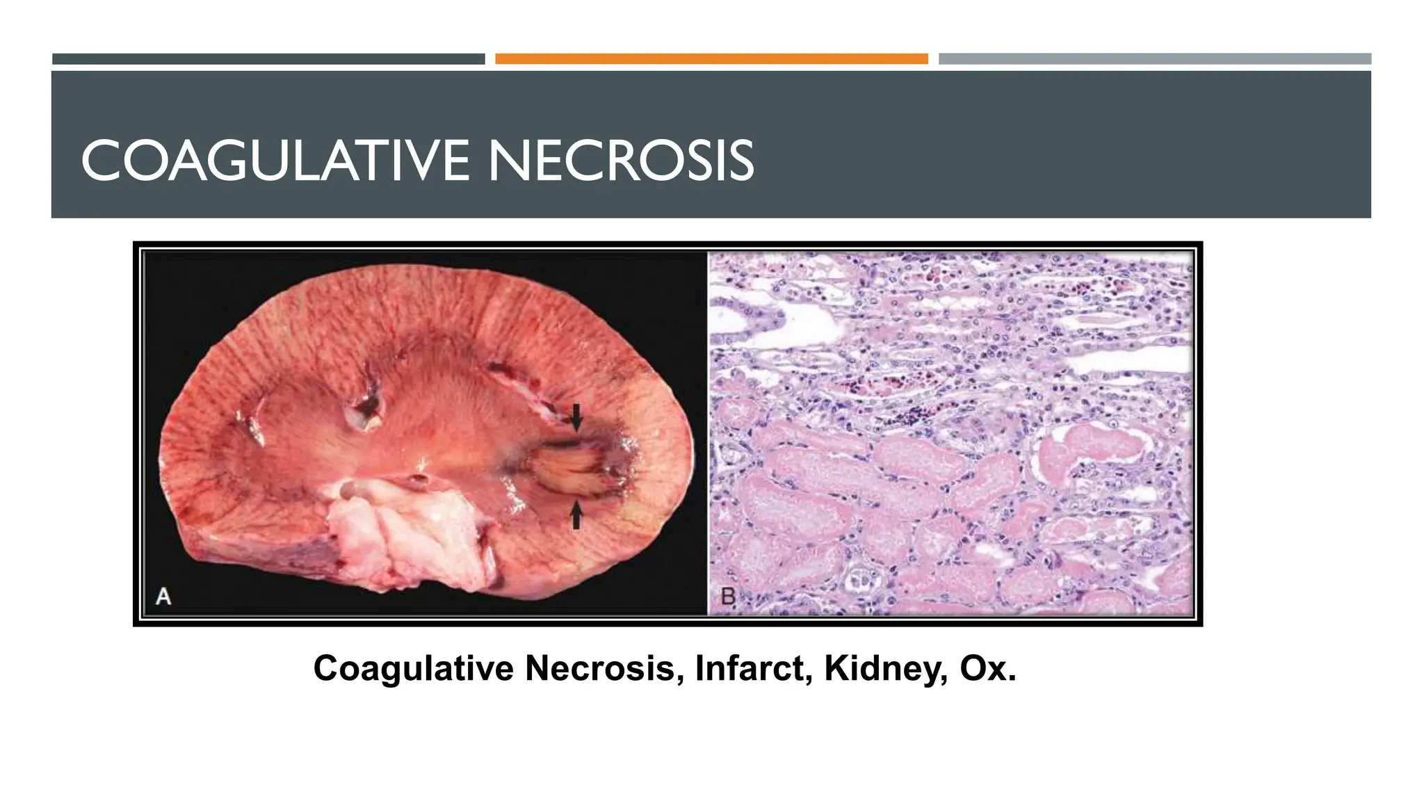 Necrosis_removed.pdfhhhhhhhhhhhhhhhhhhhh | PDF