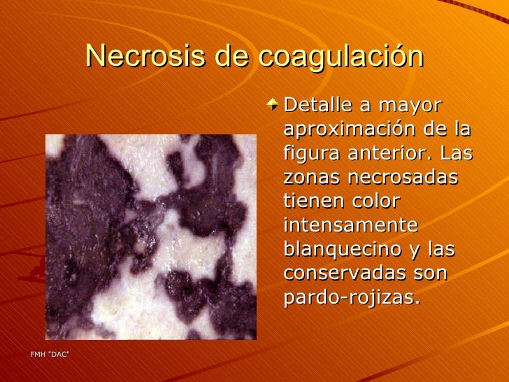 Necrosi sss