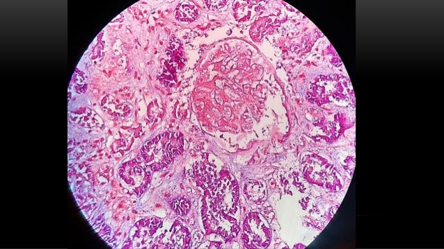 CASO CLINICO: Necrosis tubular aguda