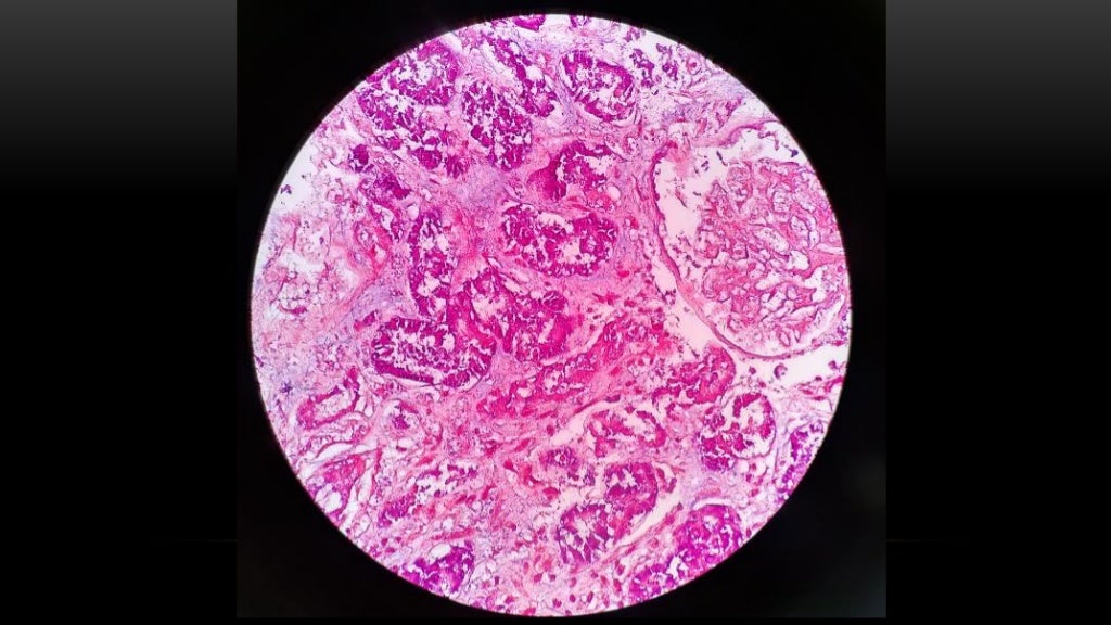 CASO CLINICO: Necrosis tubular aguda