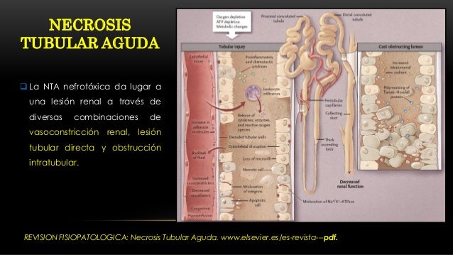 CASO CLINICO: Necrosis tubular aguda