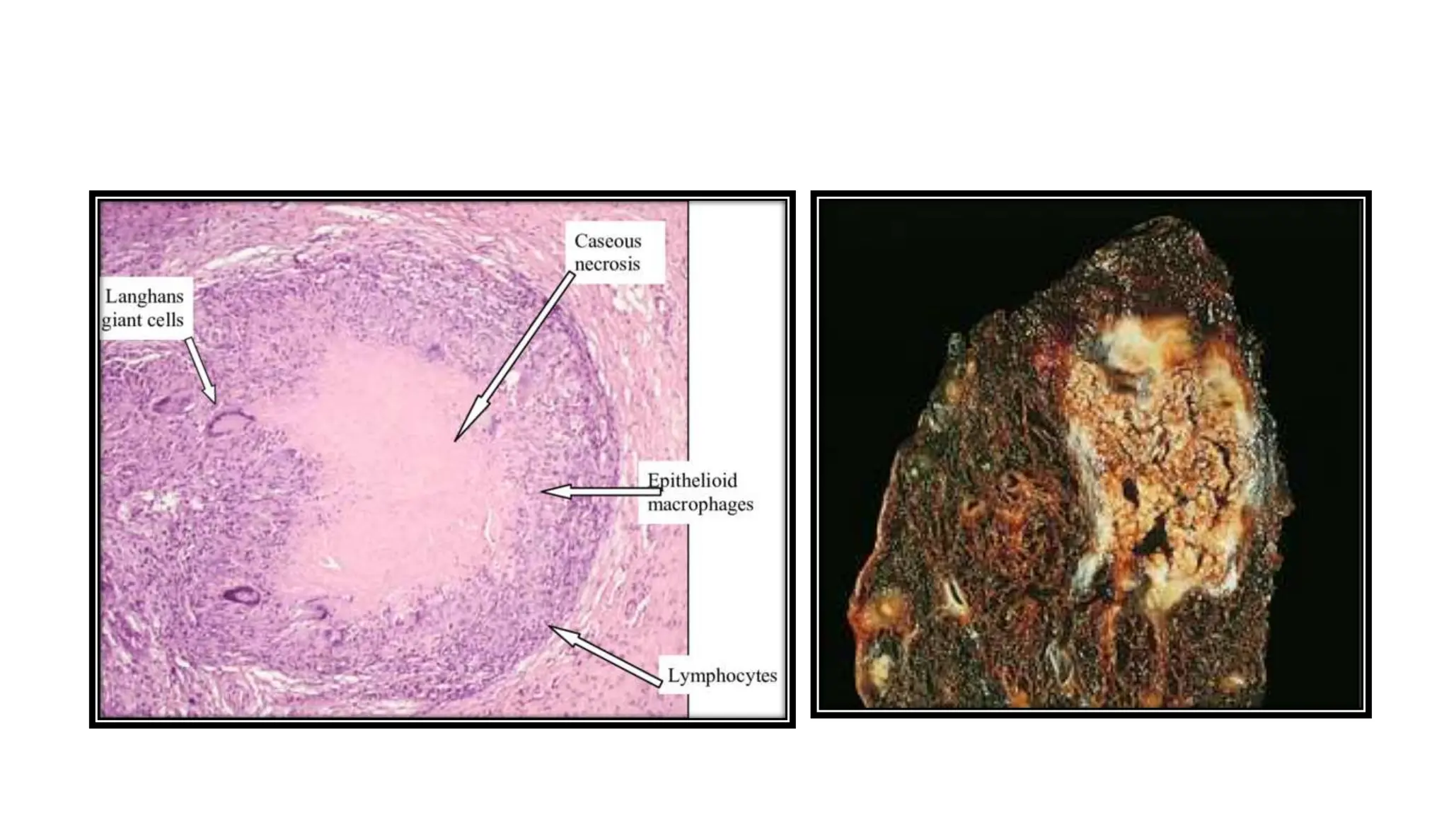 Necrosis updated pathology powerpoint presentation .pptx