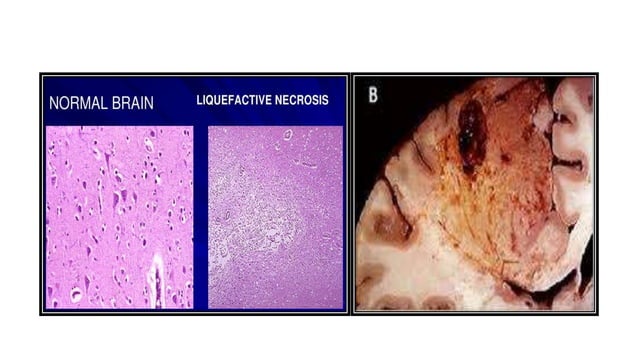 Necrosis updated pathology powerpoint presentation .pptx