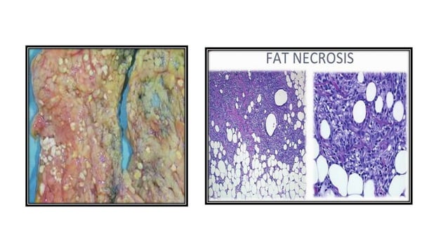 Necrosis updated pathology powerpoint presentation .pptx