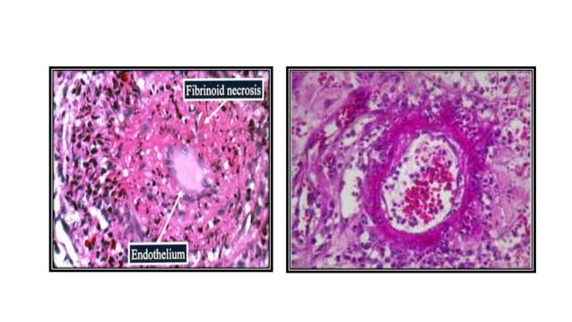 Necrosis updated pathology powerpoint presentation .pptx