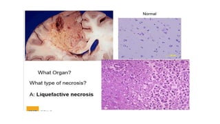 Necrosis updated pathology powerpoint presentation .pptx