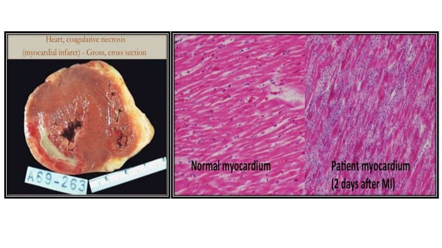 Necrosis updated pathology powerpoint presentation .pptx